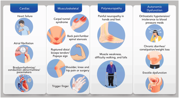 What is Cardiac Amyloidosis? - Ultromics What is Cardiac Amyloidosis? - Ultromics