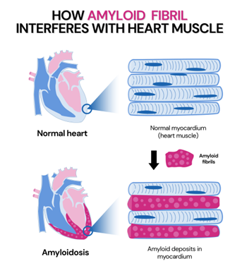 What is Cardiac Amyloidosis? - Ultromics